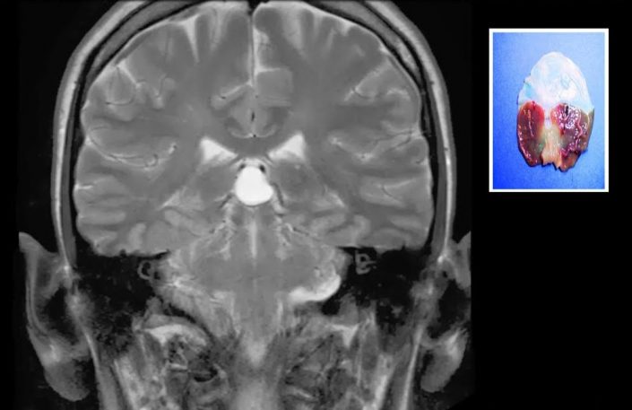 Pineal Gland Calcification | FULL HEALTH SECRETS